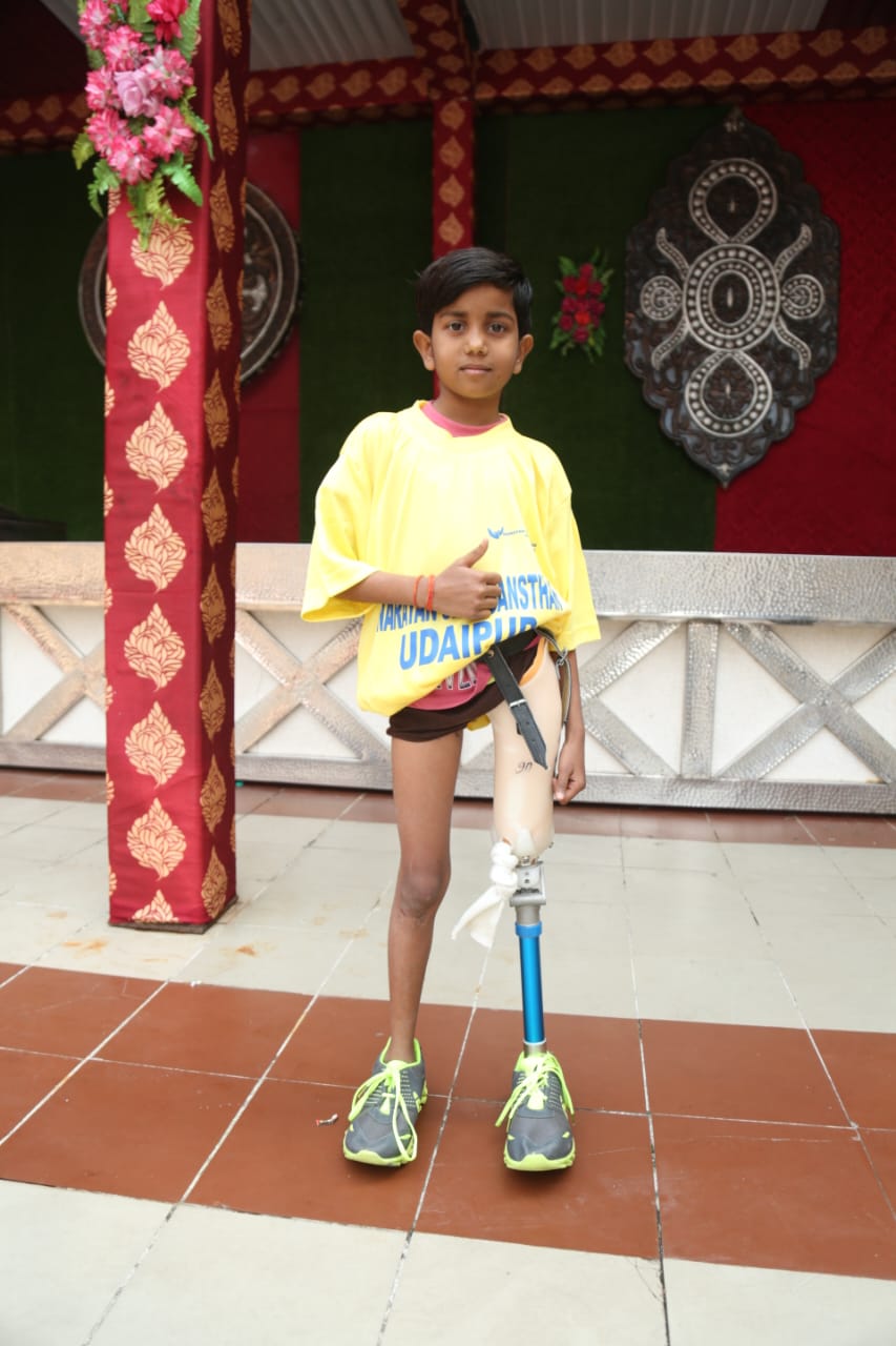 Best Artificial Limbs Cost in India - Artificial Prosthetic Leg Centre ...